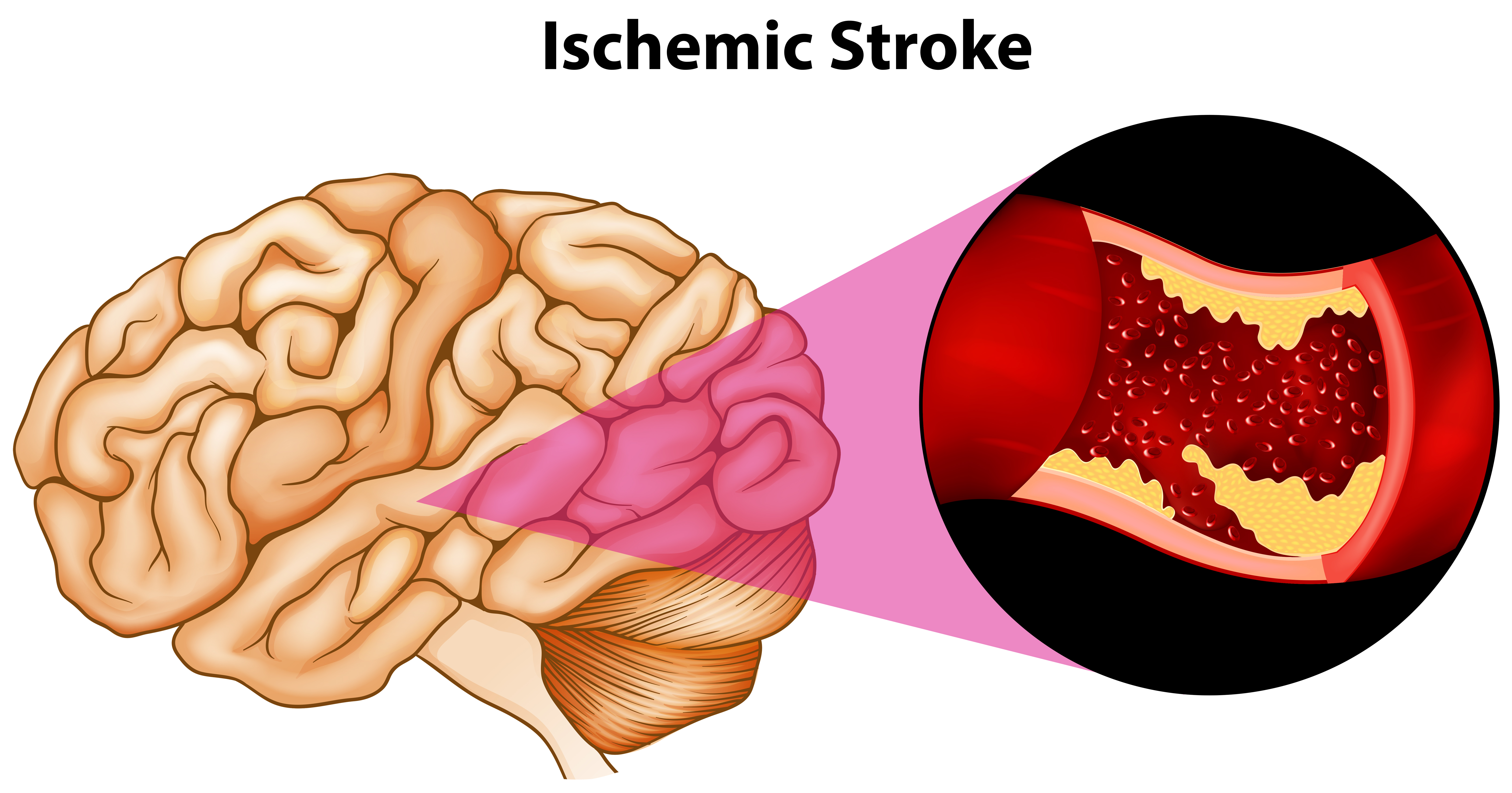 Stroke First Aid Wiki Stroke First Aid Wiki